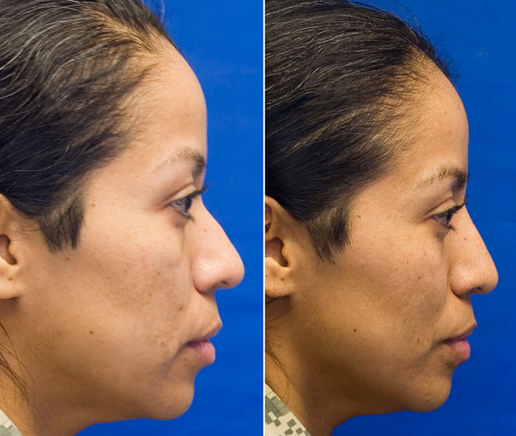 Low Radix Augmentation Rhinoplasty In Seattle Rhinoplasty Surgeon