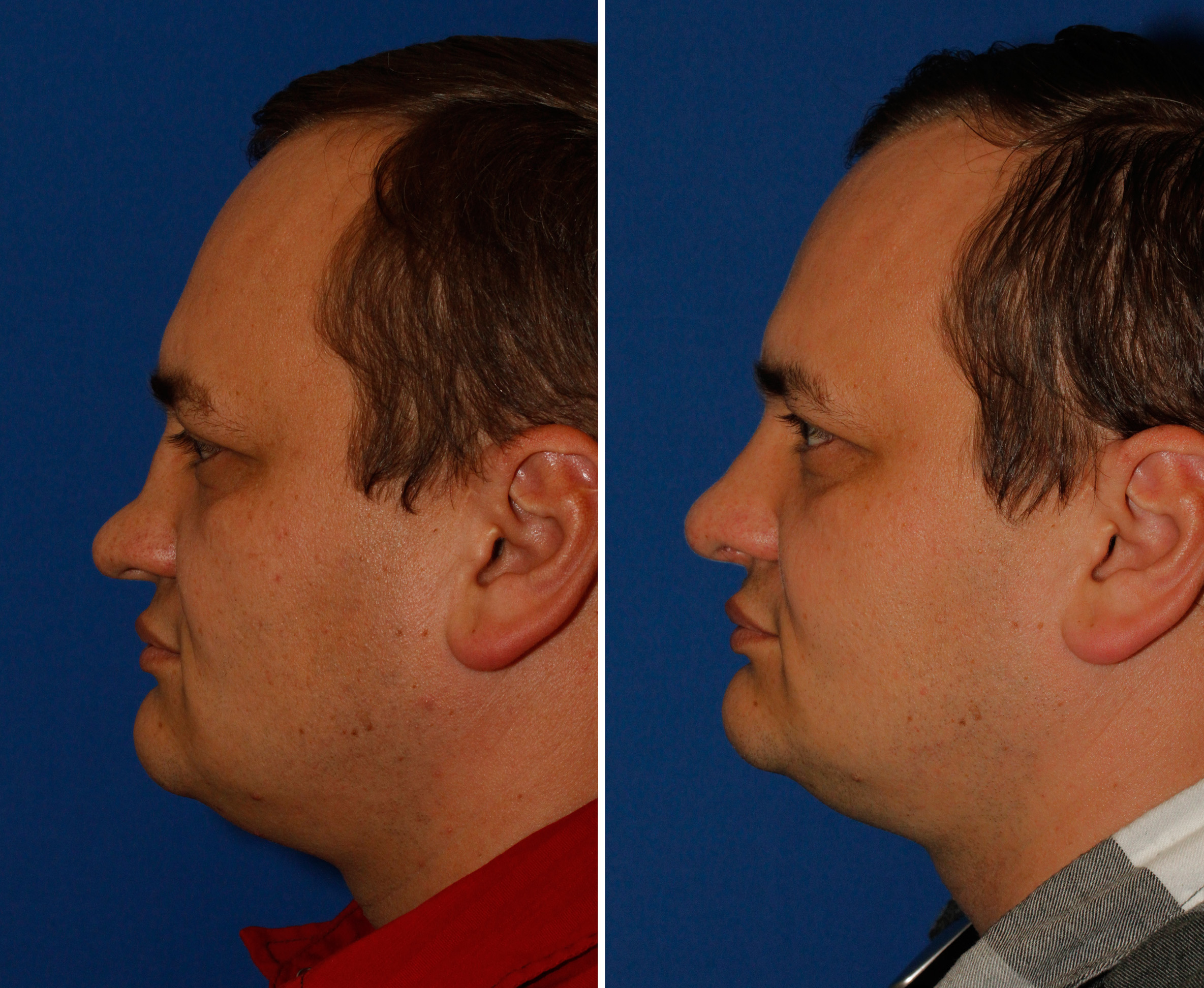 Saddle Nose Deformity Rhinoplasty In Seattle Saddle Nose Deformity Rhinoplasty In Seattle